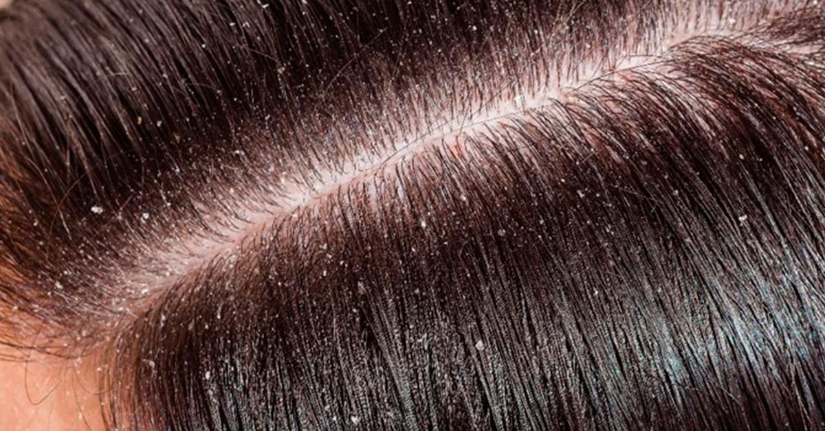 Tipos de caspa en el pelo y cómo eliminarlos